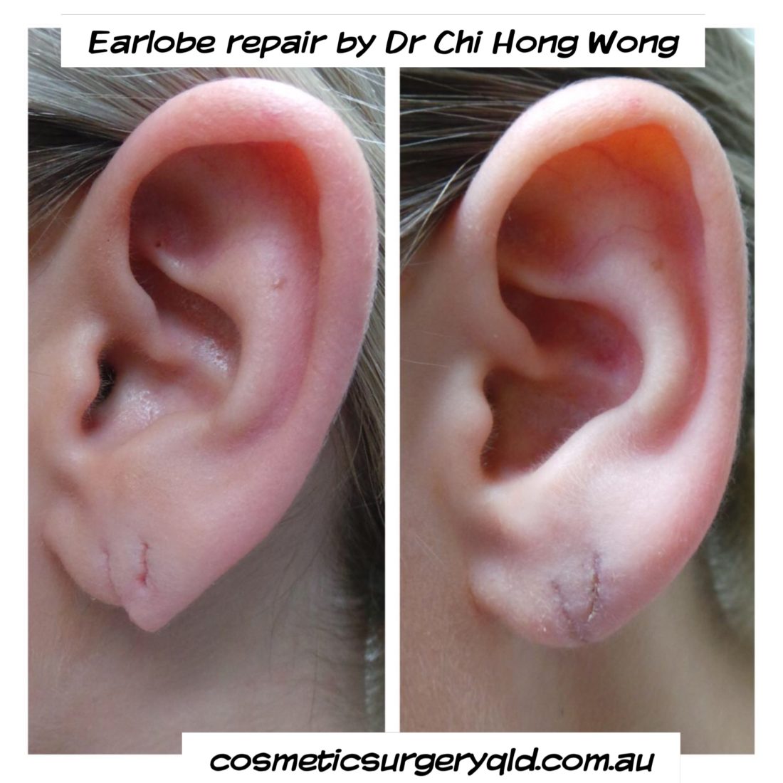 Ear Lobe Repair Surgery in Brisbane very experienced doctor
